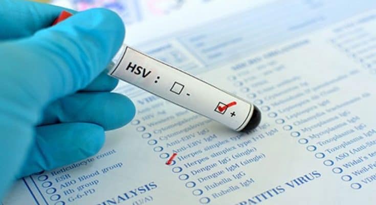 Stop HSV – Top Ways to Treat Herpes