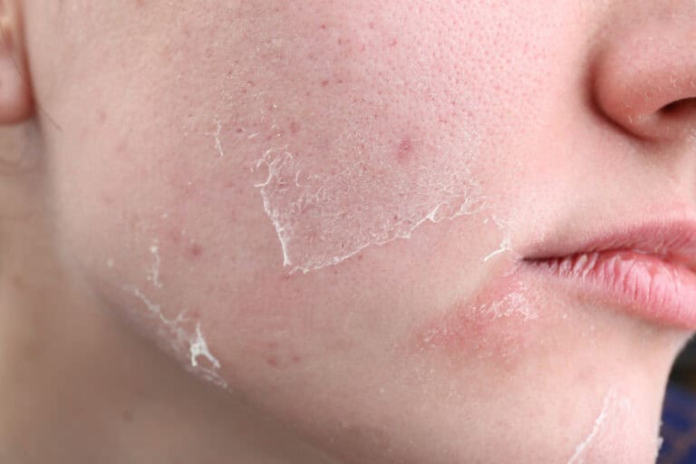 Understanding Dry Skin: Causes, Prevention, And Treatment